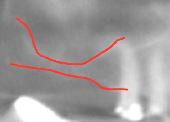 Live Surgeries Advanced Bone Grafting Cases | Live Implant Training ...