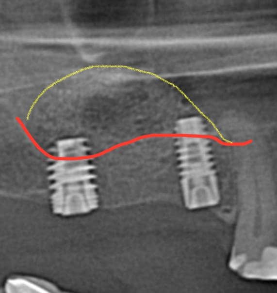 Live Surgeries Advanced Bone Grafting Cases | Live Implant Training ...